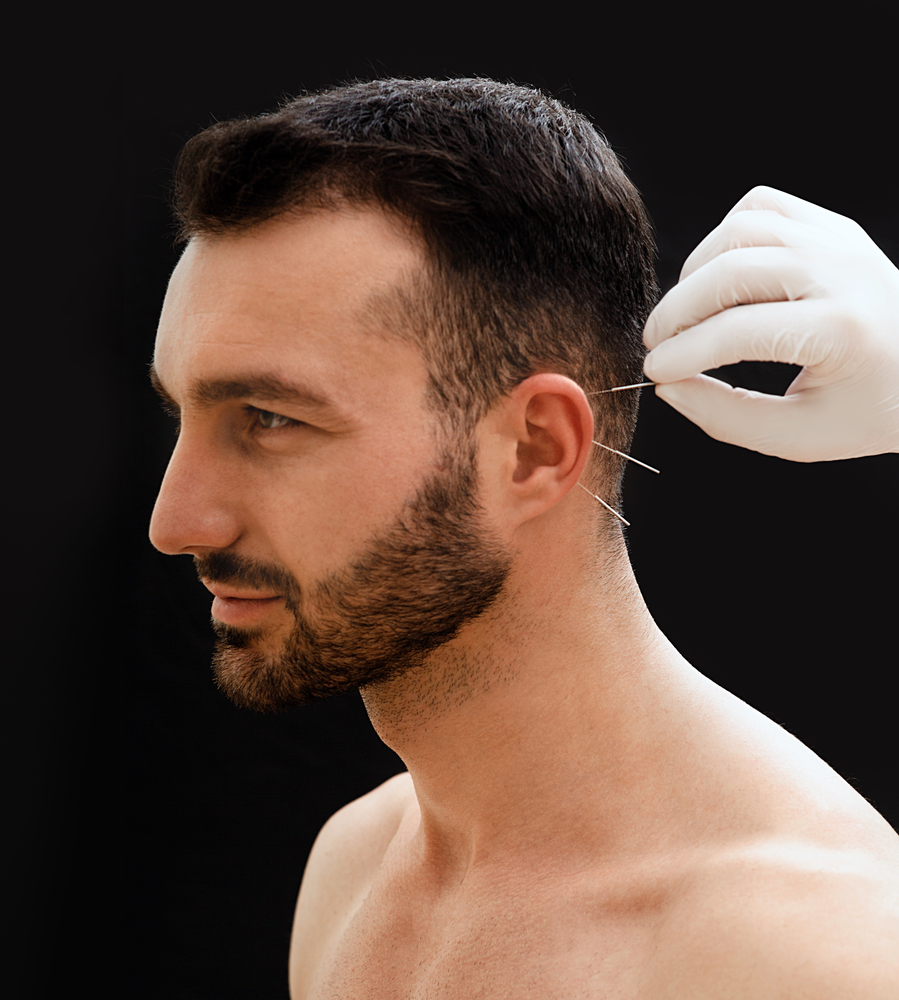 See What Acupuncture can do for Weight Loss!